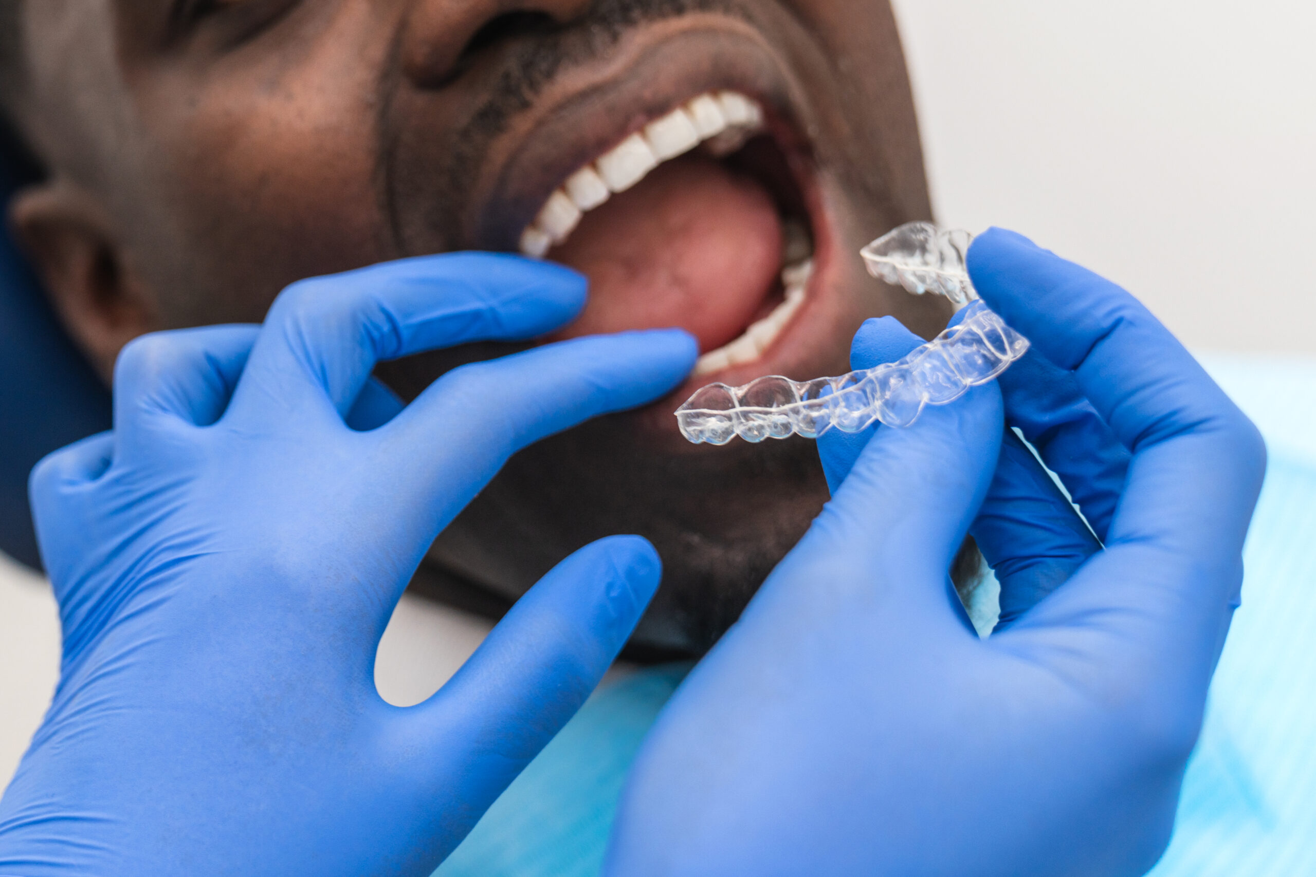Retainer Care After Clear Braces | Post-Treatment Guide